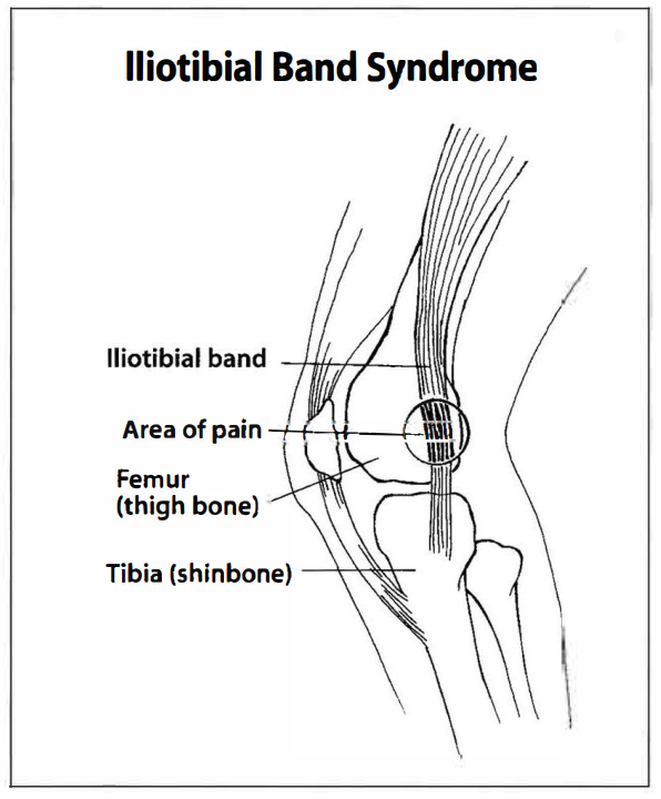 Iliotibial (IT) Band Syndrome - Luskin Orthopaedic Institute for Children